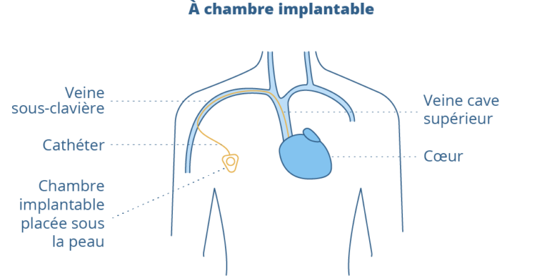 ADAIRC - La nutrition parentérale à domicile